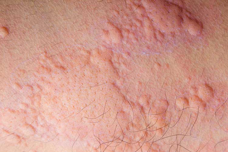 Fotos de urticaria (alergia en la piel) | MD.Saúde