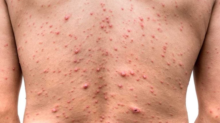 Assaduras no bebê (dermatite da fralda)