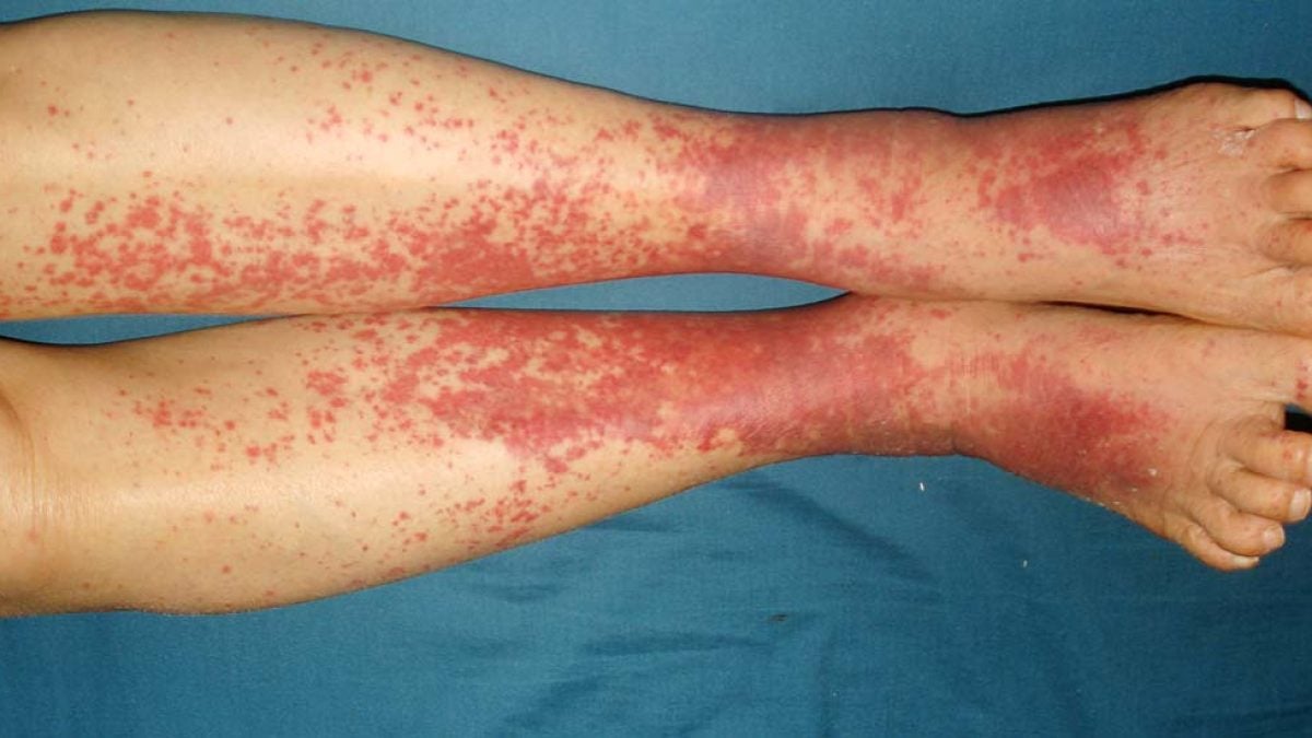 Síntomas De La Arteritis Arterial