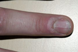 Fotos de tipos de verrugas da pele