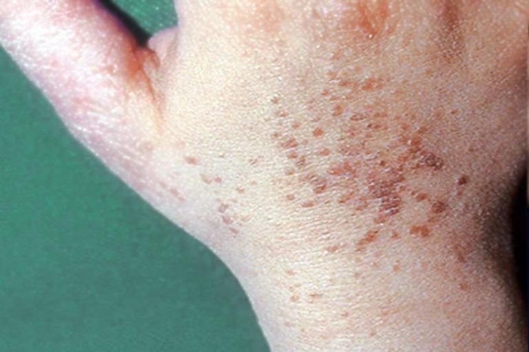 Fotos de tipos de verrugas da pele