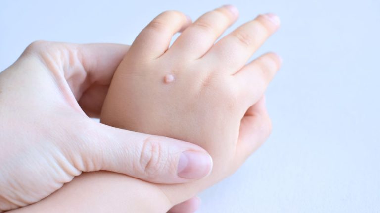 Fotos de tipos de verrugas da pele