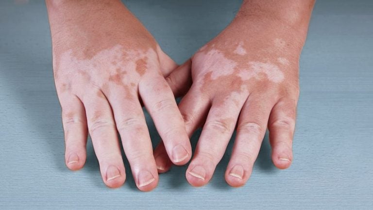 Vitiligo | O que é, causas, sintomas e tratamento