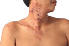 Photos of shingles (herpes zoster)